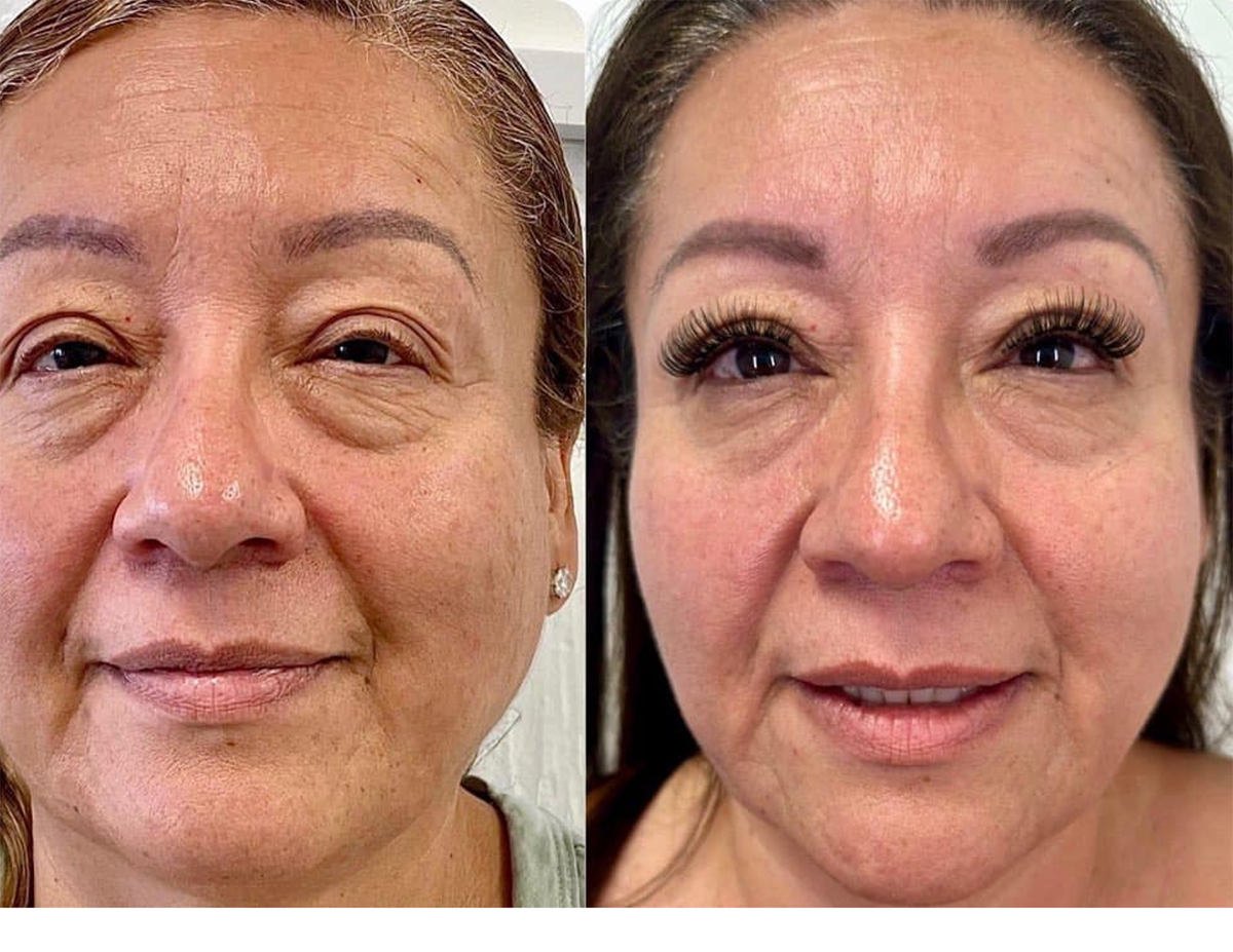 Eyelid Lift. Jet Plasma. Treatment to lift Eyelids. Quick,UK