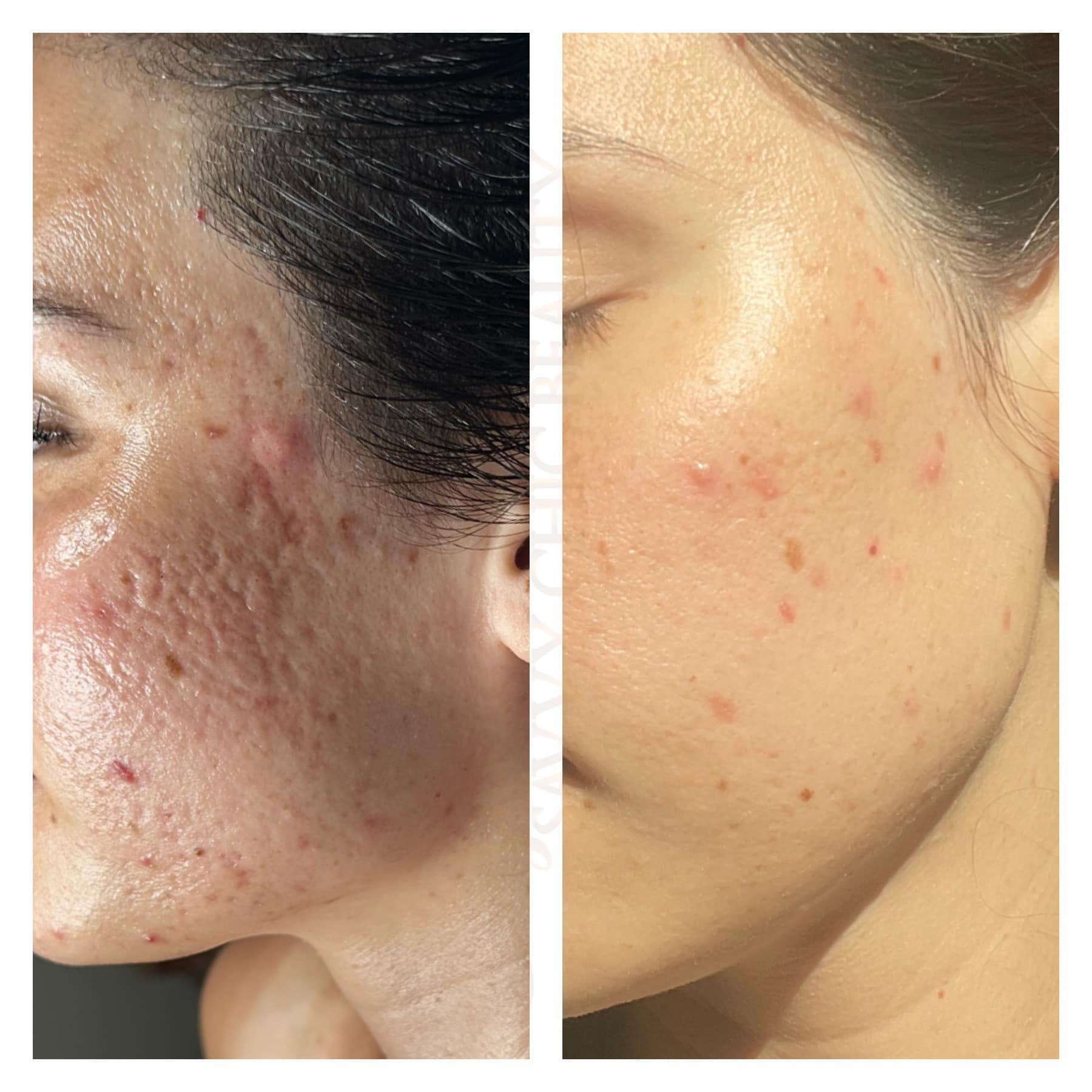 Acne Scaring. Jet Plasma. Reduce Acne Scars. Smooth Skin.